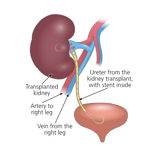 Kidney Transplant - Liver and Pancreatic Transplant Surgeon in Dubai